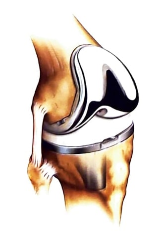 Jiffy Knee™ Subvastus Quad-Sparing Total Knee Replacement - Dr. Samani ...